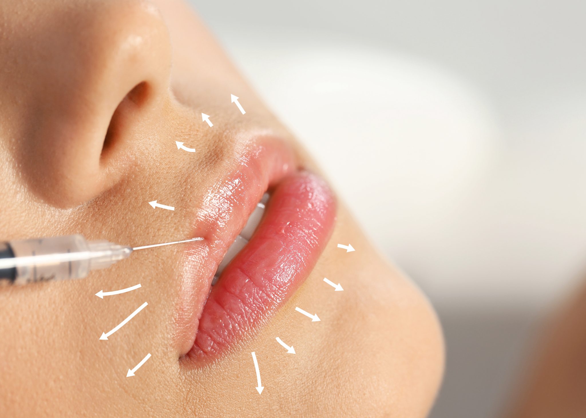 Lip Filler Trends: Natural vs Plump Pout—What’s Right for You? - Prime ...