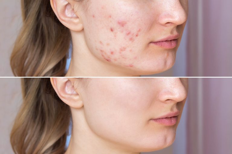 The Truth About Skin Purging vs Breakouts - Prime Med Spa